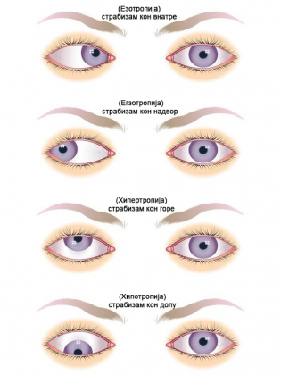 Страбизам • Оптометрија.мк